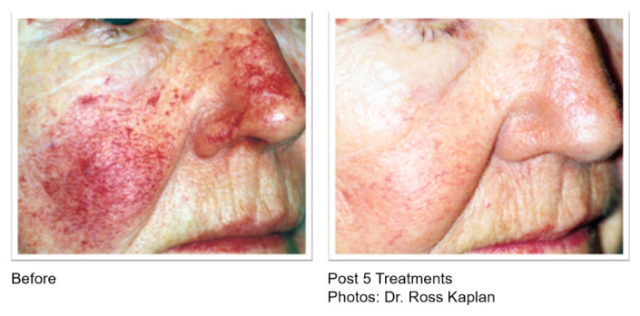 Traitement des lésions vasculaires (couperose, points rubis, angiomes ...