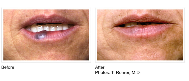 Traitement des lésions vasculaires (couperose, points rubis, angiomes ...