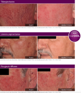 Traitement des lésions vasculaires (couperose, points rubis, angiomes ...