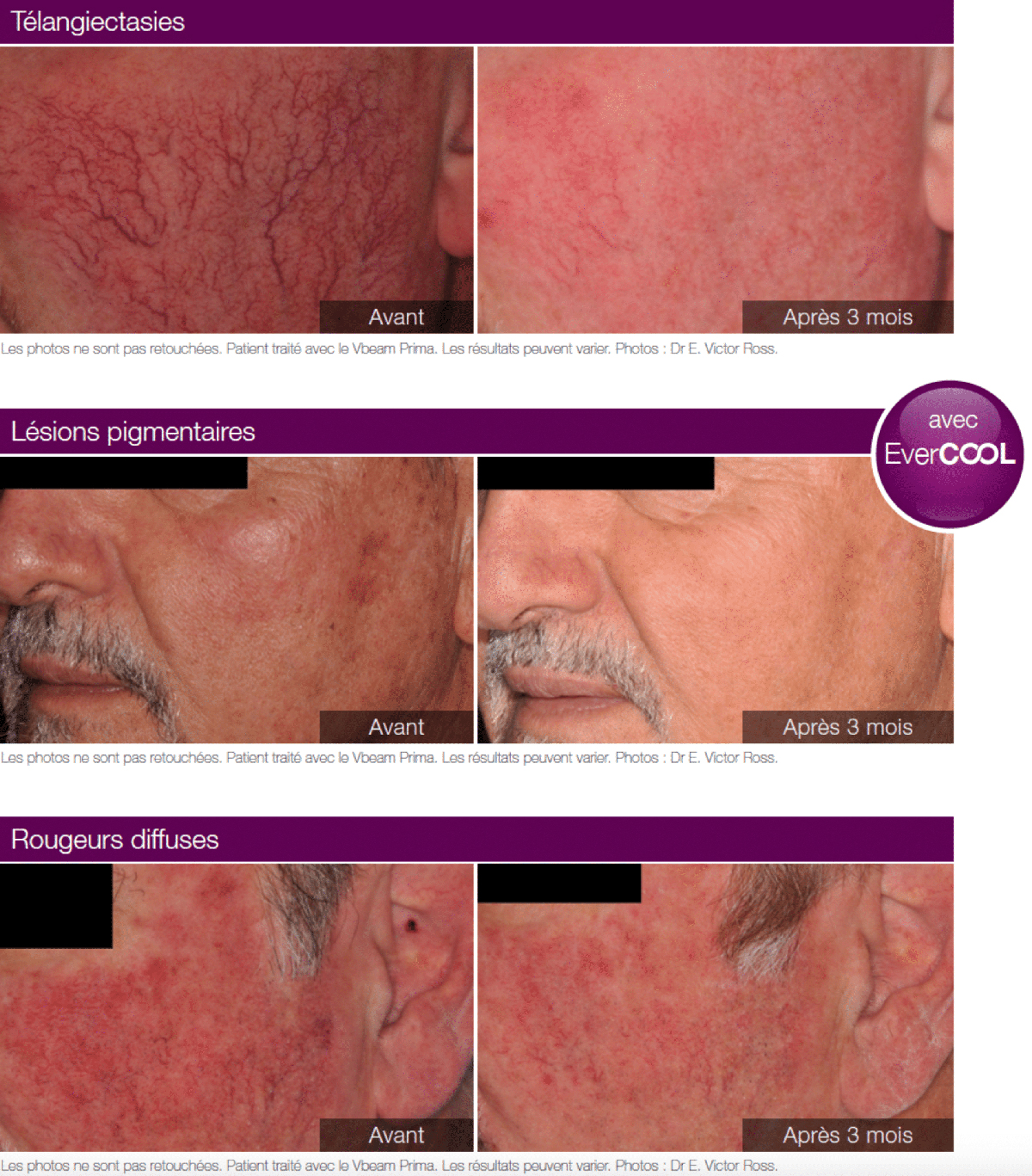 Traitement des lésions vasculaires (couperose, points rubis, angiomes ...